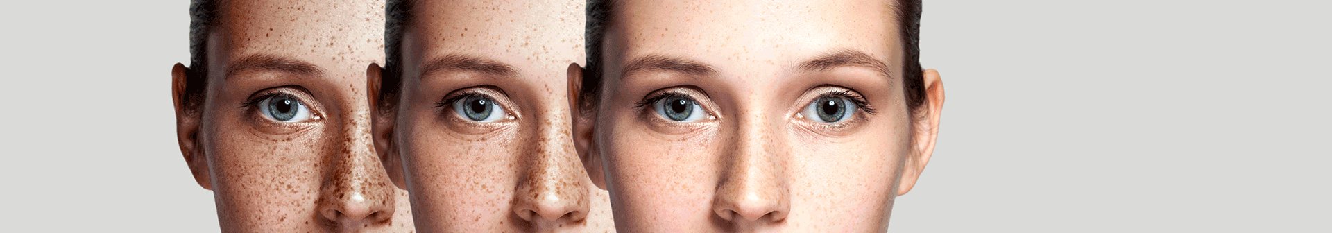 Macchie Solari Viso: Rimedi per Trattarle e Contrastarle | Garnier