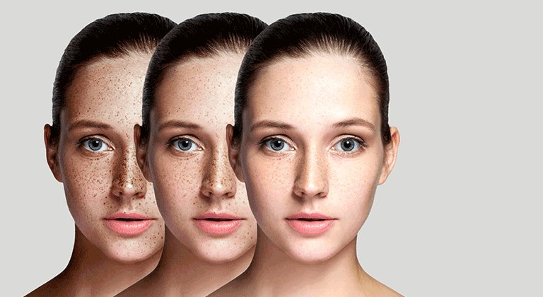 Macchie Solari Viso: Rimedi per Trattarle e Contrastarle | Garnier